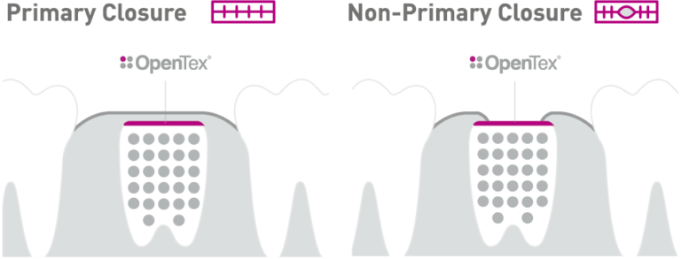 OpenTex® – Non-Resorbable PTFE Membranes for GBR | Purgo Biologics USA